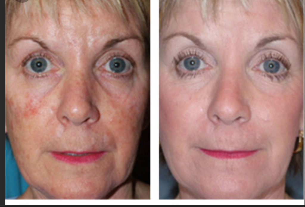 Cryo Care Services – Cyro Care