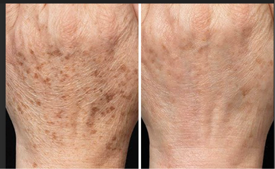 Cryo Care Services – Cyro Care